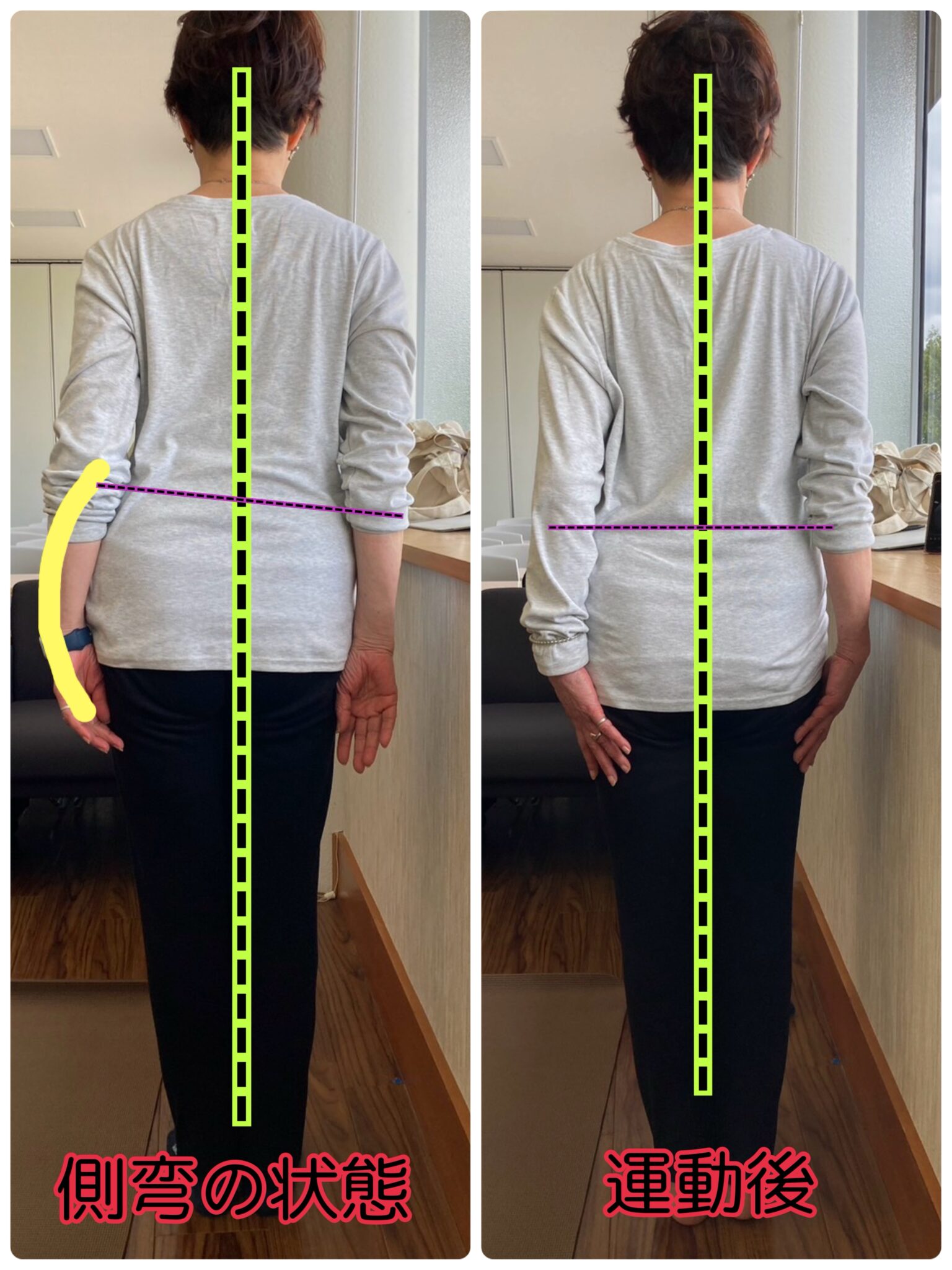 実は多い隠れ側弯症！ヨガで実践する身体の歪みチェックと改善運動 【SUAY-LABO】